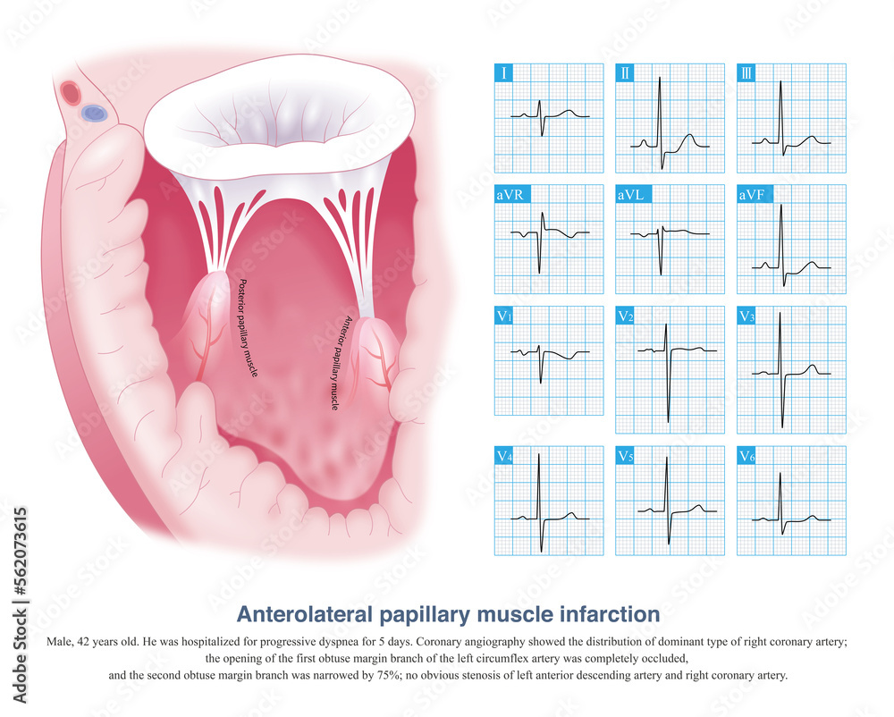 When the anterolateral papillary muscle infarction occurs, the ST ...