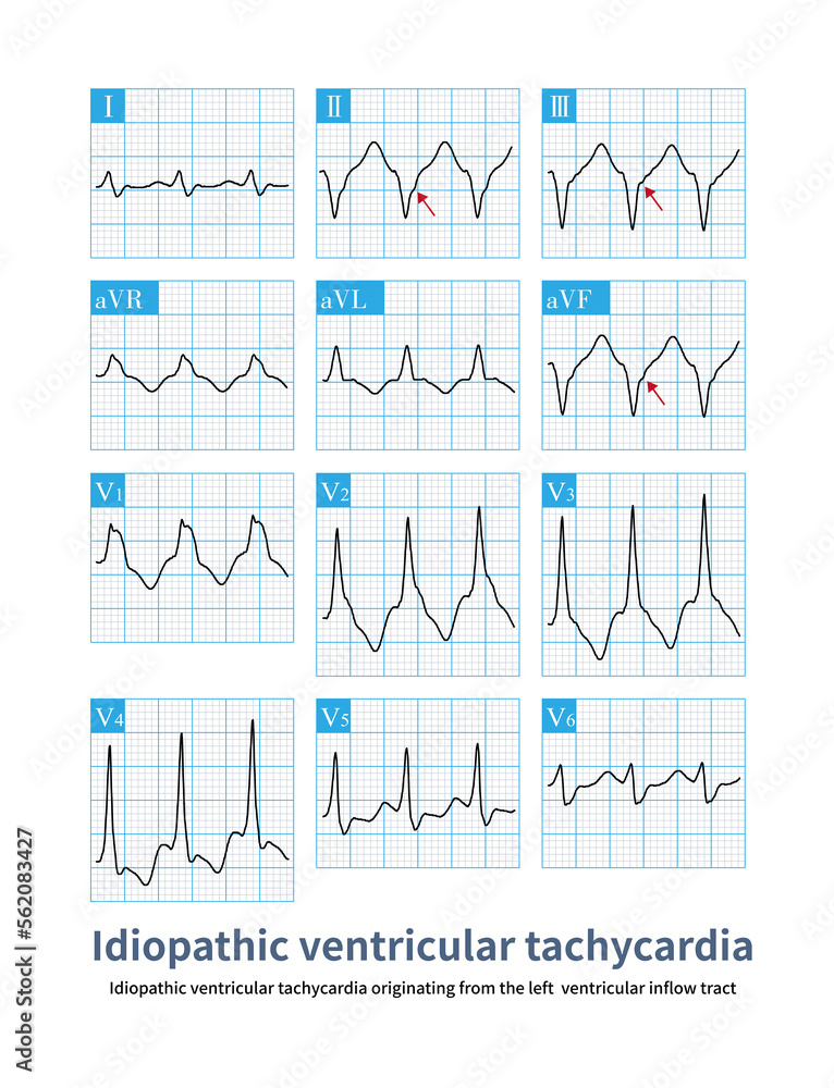 This case of ventricular tachycardia originated from the left ...