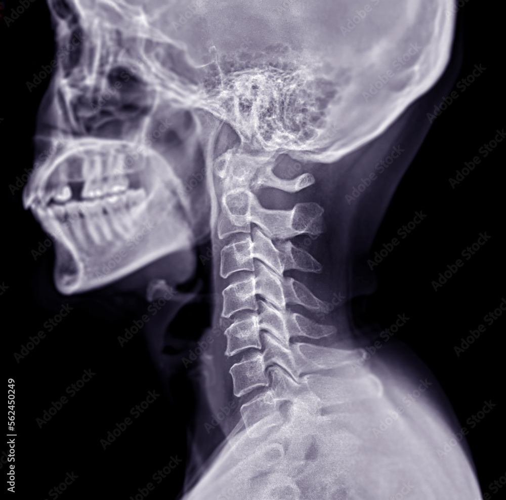 X-ray C-spine or x-ray image of Cervical spine lateral view for diagnostic intervertebral disc ...