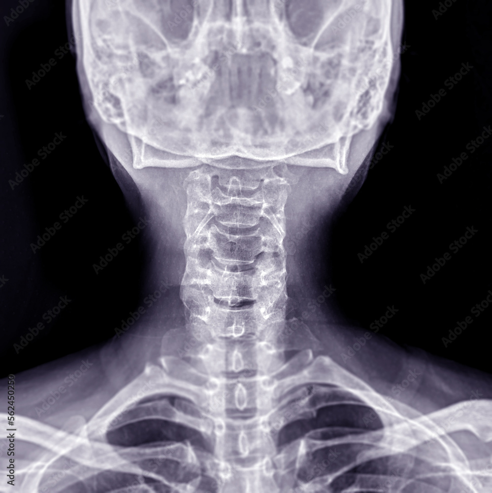 Foto de Stock X-ray C-spine or x-ray image of Cervical spine AP view ...