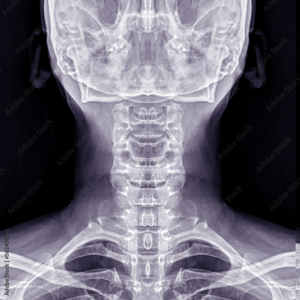 Стоковое фото «X-ray C-spine or x-ray image of Cervical spine AP view ...