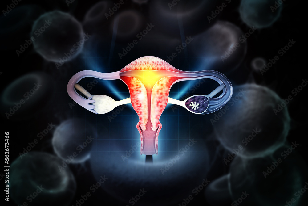 Female reproductive system diseases. Uterus cancer and endometrial ...