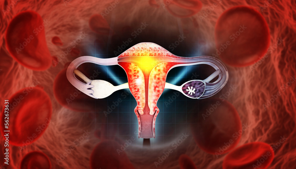 Female reproductive system diseases. Uterus cancer and endometrial ...
