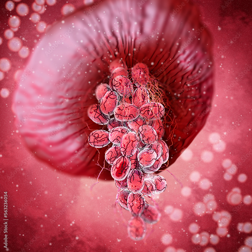 Medical background, Staphylococcus aureus, a type of spherical gram ...