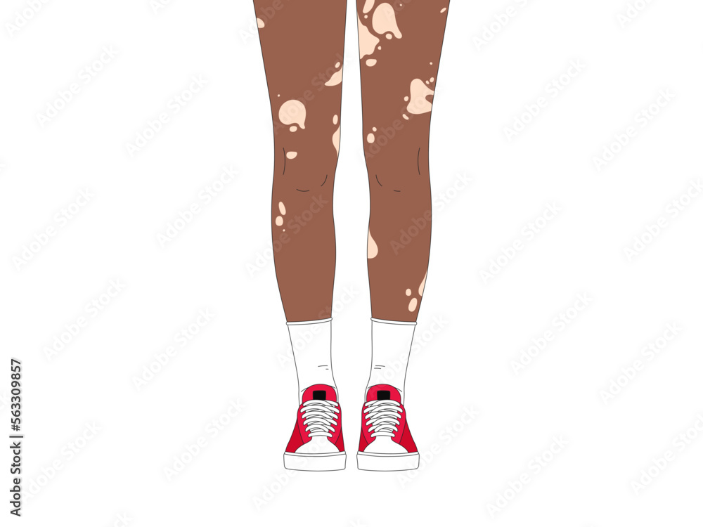 Vector vitiligo skin illustration. Beautiful vitiligo black girl legs ...