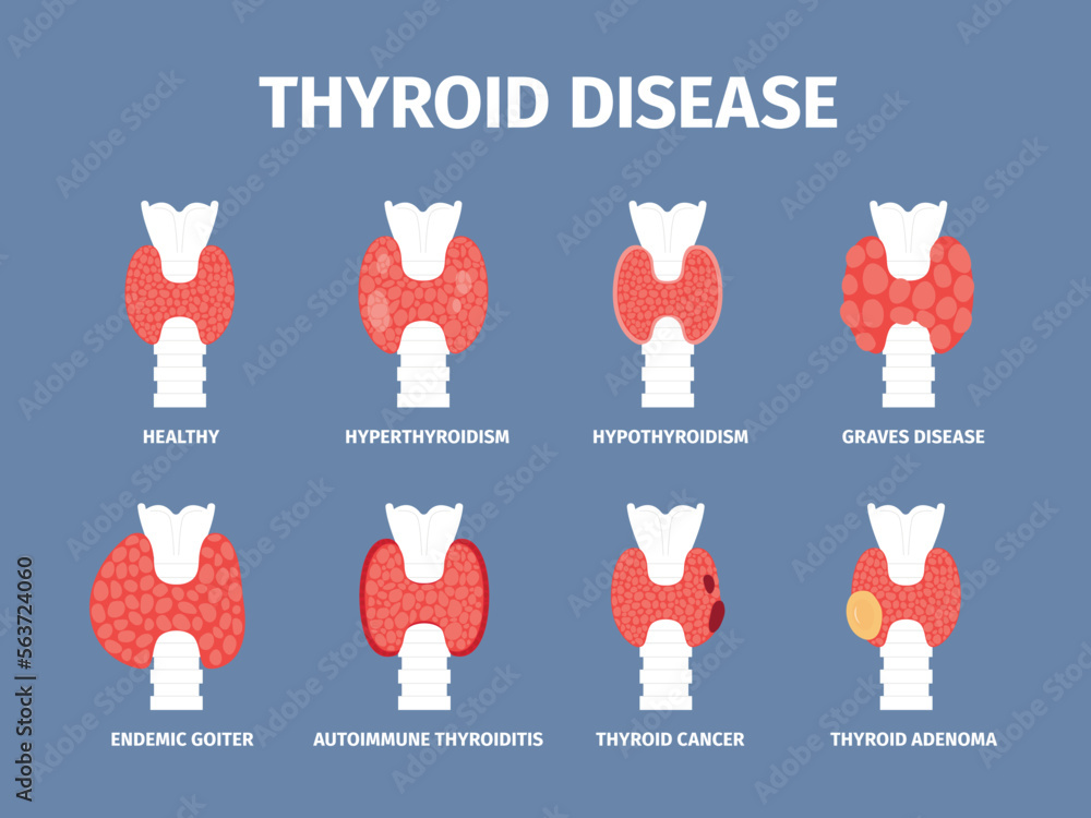 Thyroid gland various diseases. Goiter and hyperthyroid, inflammation ...