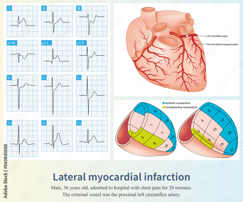 When the proximal segment of the left circumflex artery is occluded, it ...