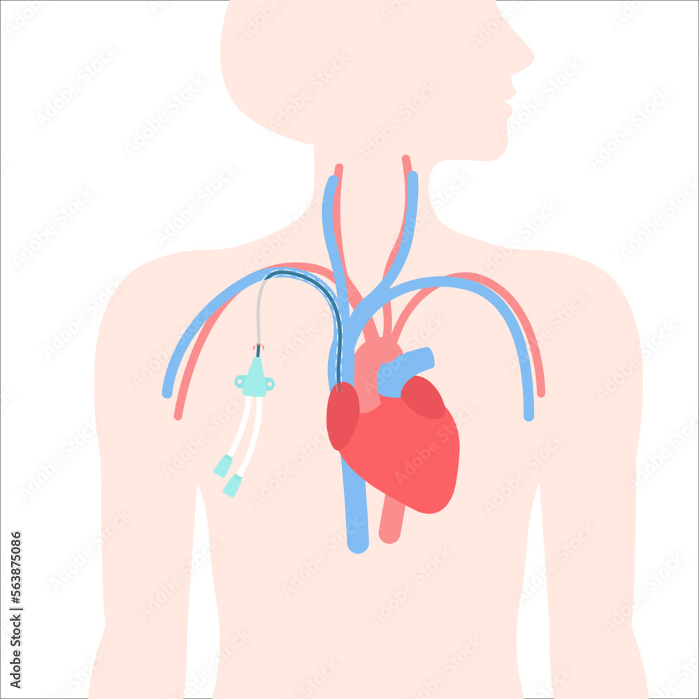 Tunneled central venous catheter placed in the subclavian vein. Patient ...