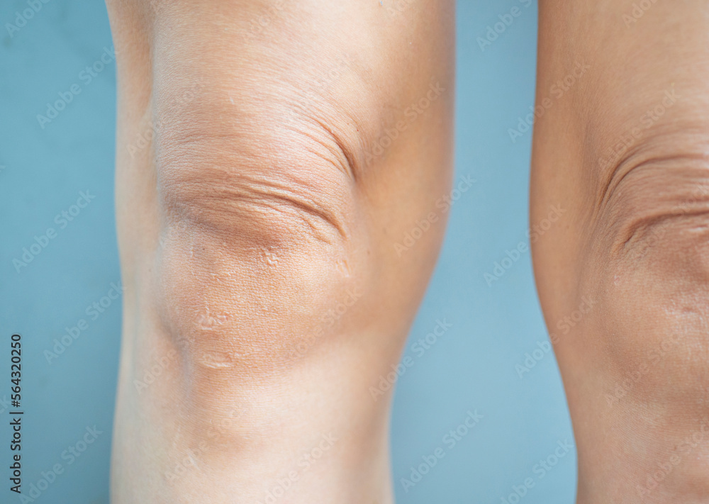 Foto de Stock lesion, dermatitis dark spots of the skin on the legs ...