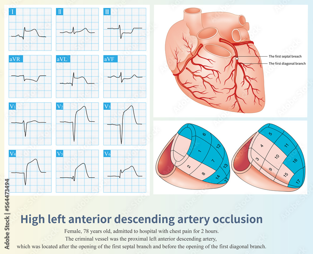 The occlusion of the proximal left anterior descending artery can cause large area of anterior ...