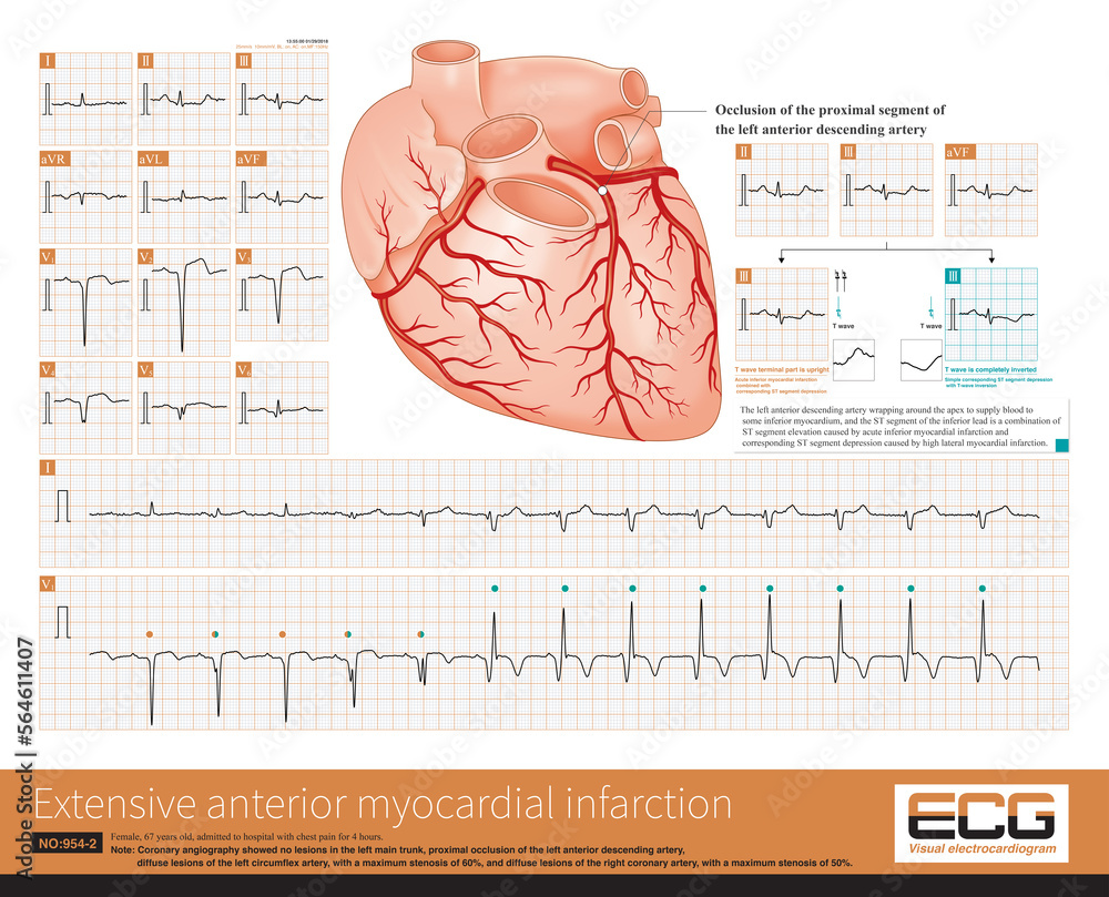The proximal occlusion of the left anterior descending artery leads to a large area of anterior ...