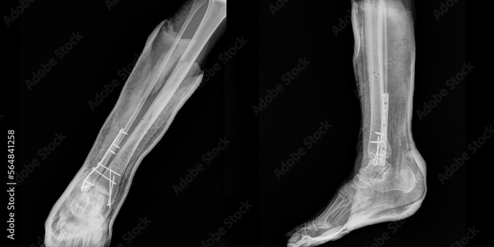 Radiography of osteosynthesis of the ankle joint Stock Photo | Adobe Stock