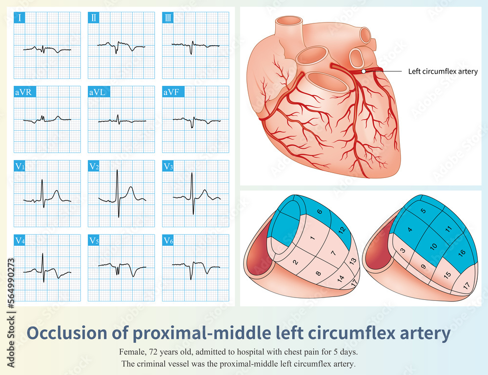 The occlusion of the proximal and middle left circumflex artery can lead to myocardial ...