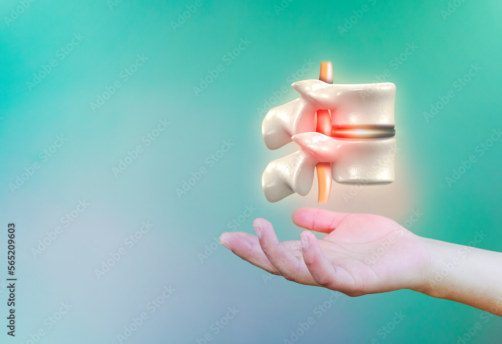 Spinal herniation, herniated disc. Low back pain. Spine. Intense disc ...