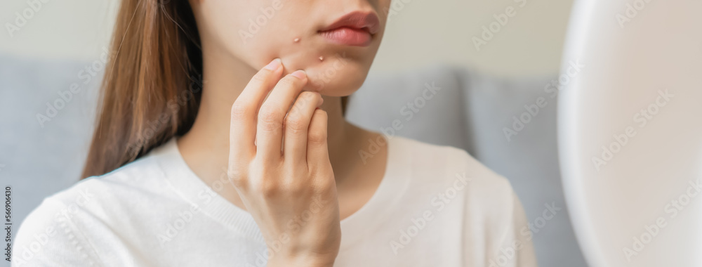 Foto de Stock Expression worry asian young woman hand touching pustule ...