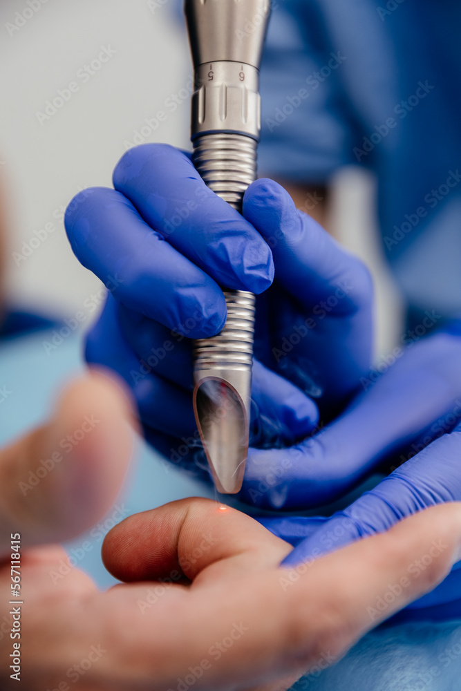 The doctor removes moles and warts with a laser beam. Mole removal ...
