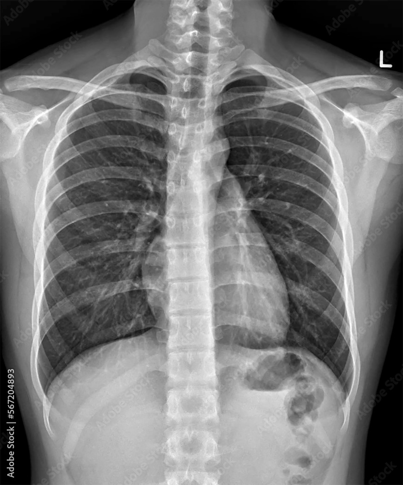 Plain radiograph on dark background in hospital. The film use for ...