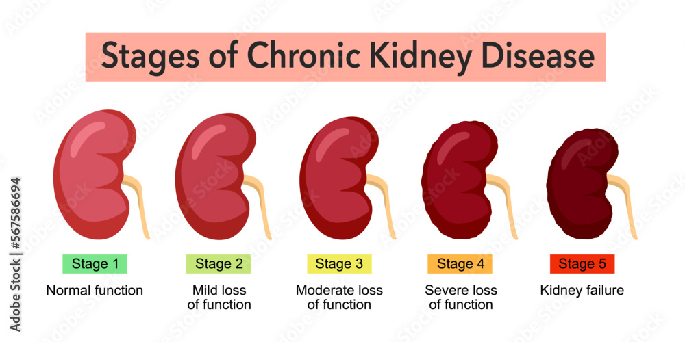 Stages of chronic kidney disease infographic concept vector ...