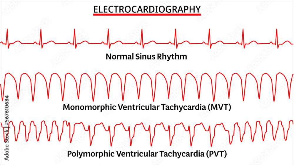 Set of ECG Common Abnormalities - Normal Sinus Rhythm - Monomorphic VT ...