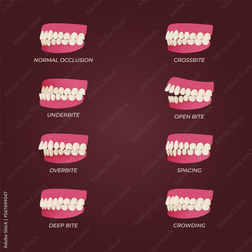 Human teeth malocclusion set with realistic images of mouth jaws with ...