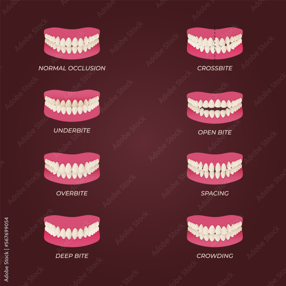 Human teeth malocclusion set with realistic images of mouth jaws with ...