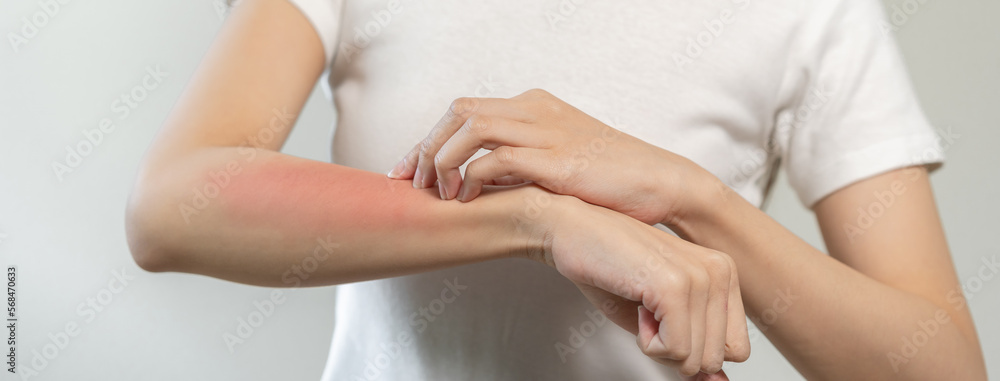 Dermatology asian young woman, girl allergy, allergic reaction from ...