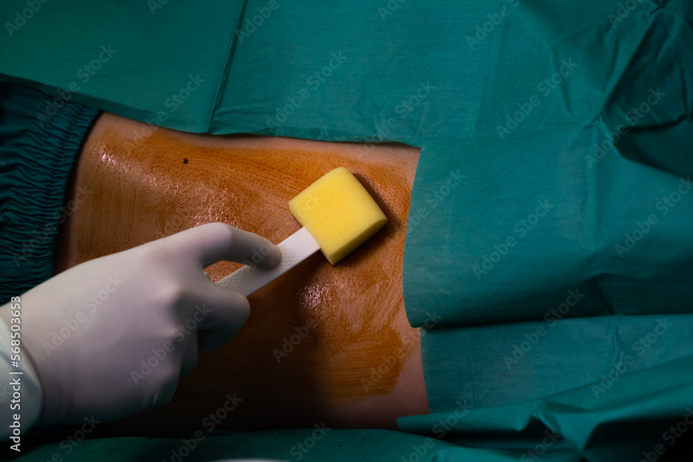 Doctor or surgeon apply betadine to the patient for anesthesia ...