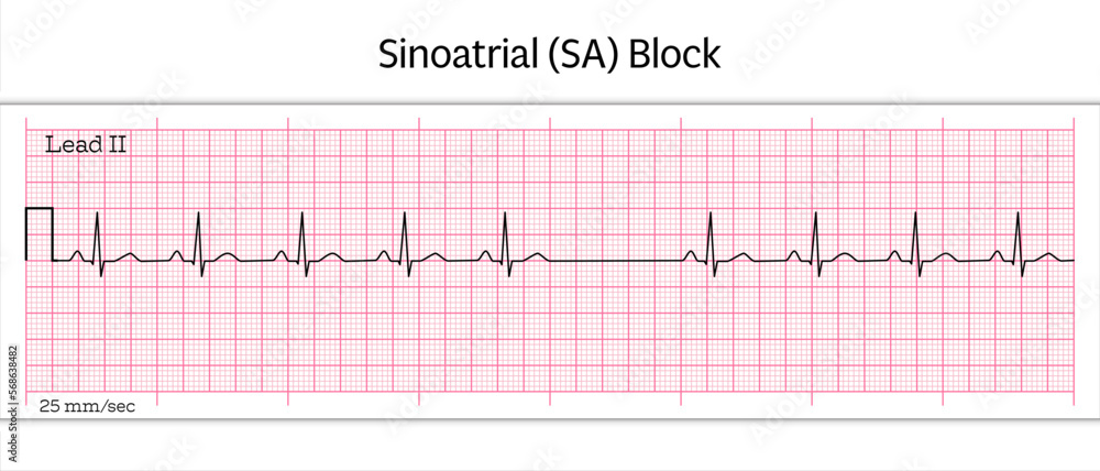 Sinoatrial (SA) Block ECG - 8 Second ECG Paper - Vector Medical ...