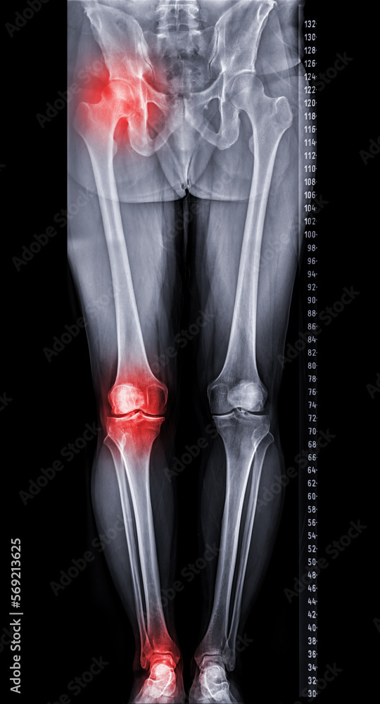 Scanogram is a Full-length standing AP radiograph of both lower ...