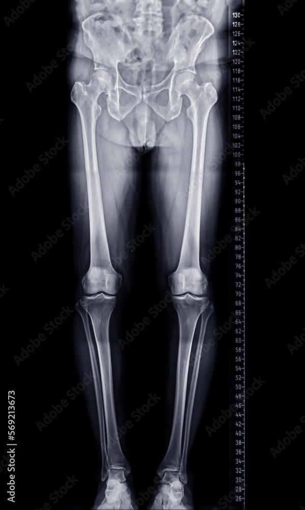 Scanogram is a Full-length standing AP radiograph of both lower extremities including the hip ...