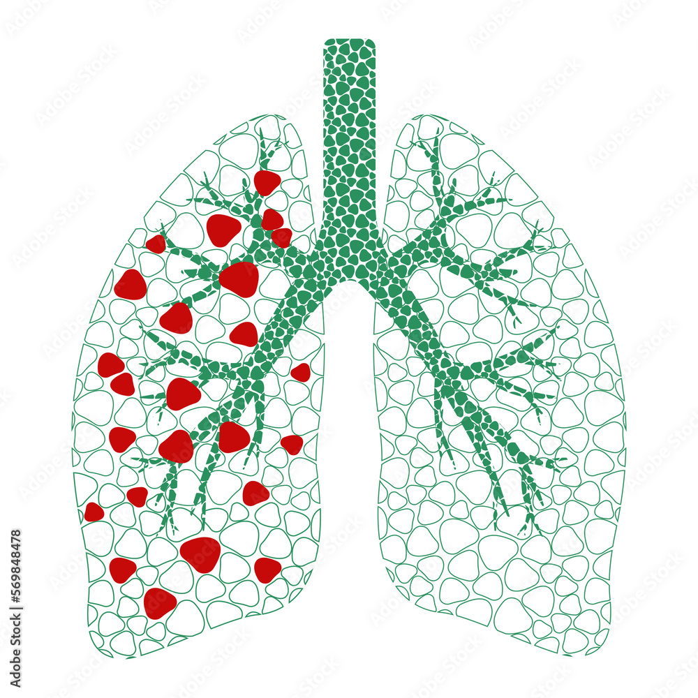 lungs illustration. Tuberculosis concept Stock Illustration | Adobe Stock