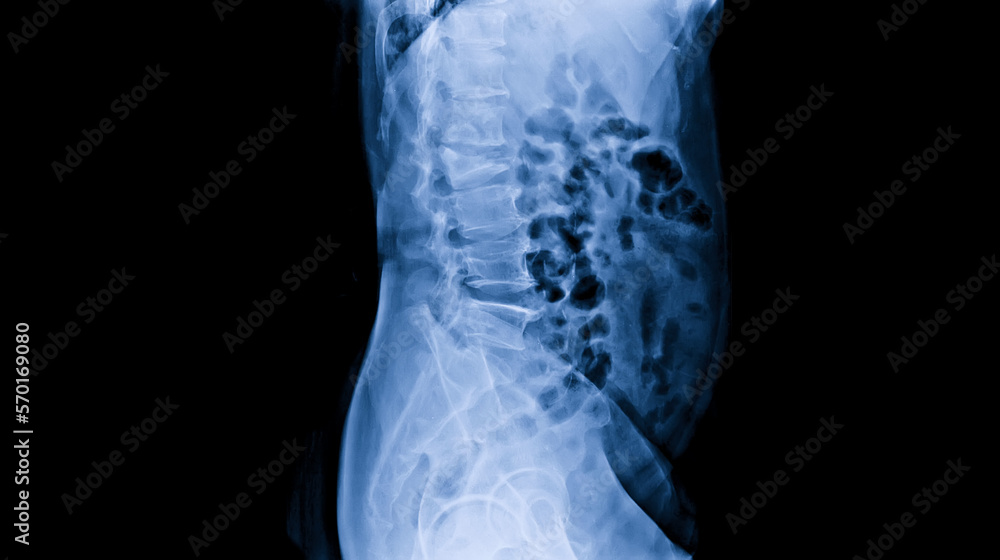 Plain radiograph on dark background in hospital.The x-ray is used for ...