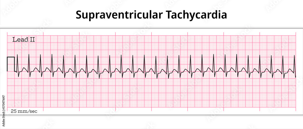 Stock-Vektorgrafik „ECG Supraventricular Tachycardia - 8 Second ECG Paper - Electrocardiography ...