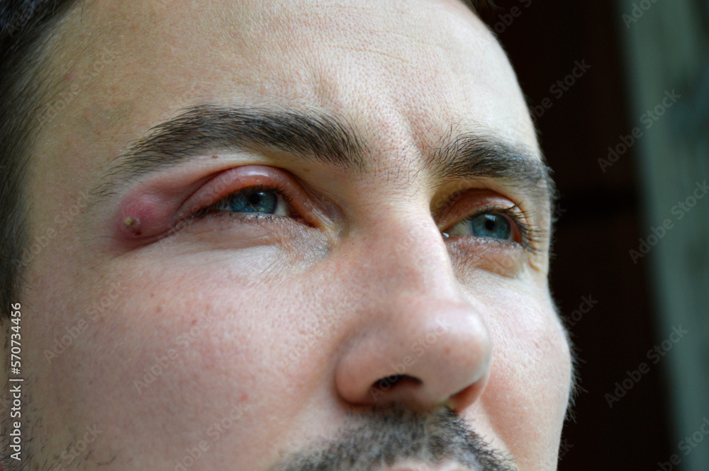 Photo Stock boil - a strong purulent abscess in a man near the eye ...
