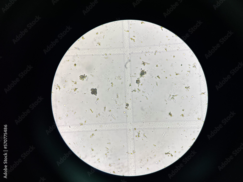 Calcium phosphate crystal in urine. Stock Photo | Adobe Stock