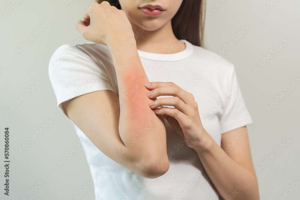 Dermatology asian young woman, girl allergy, allergic reaction from ...