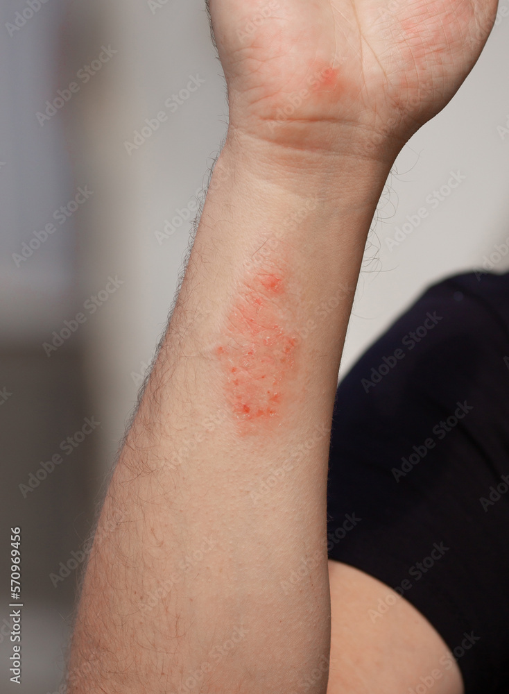 Spots, sores on human skin. Infection rash, psoriasis, eczema, lichen ...