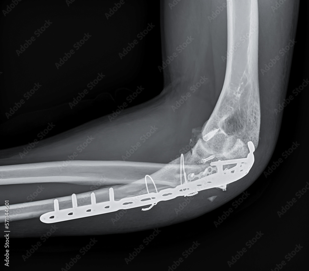 X-ray of Elbow showing internal fixation of the elbow joint. Stock ...