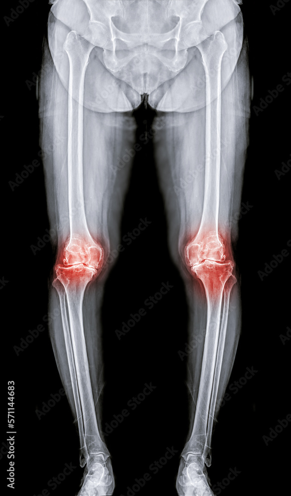 Scanogram is a Full-length standing AP radiograph of both lower extremities including the hip ...