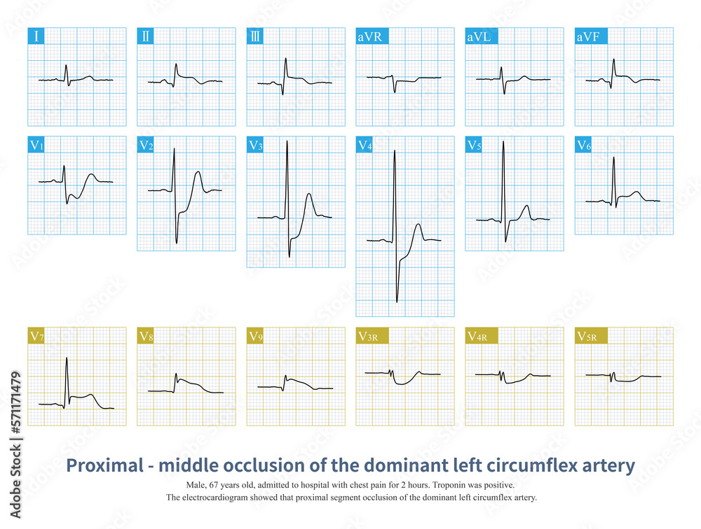 The proximal segment occlusion of the dominant left circumflex artery ...