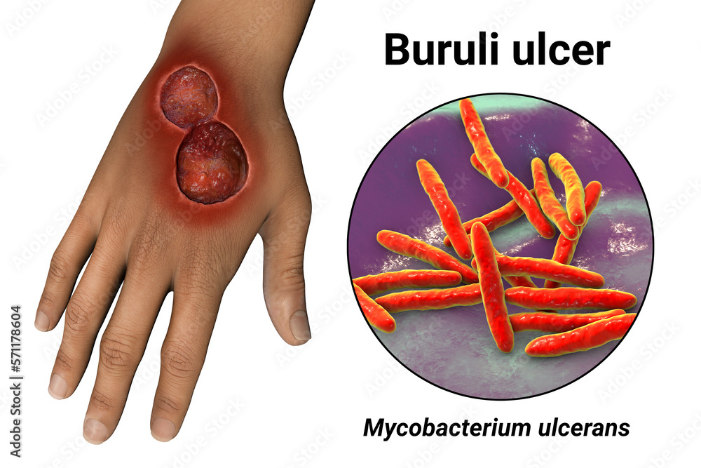 Buruli ulcer on an arm, 3D illustration. The disease caused by ...