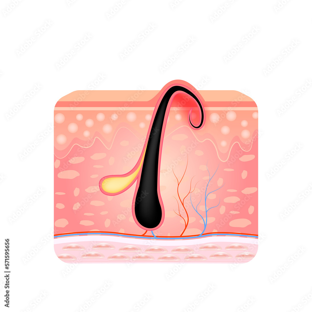 Ingrown hair. Hair has grown back into the skin surface after shaving ...