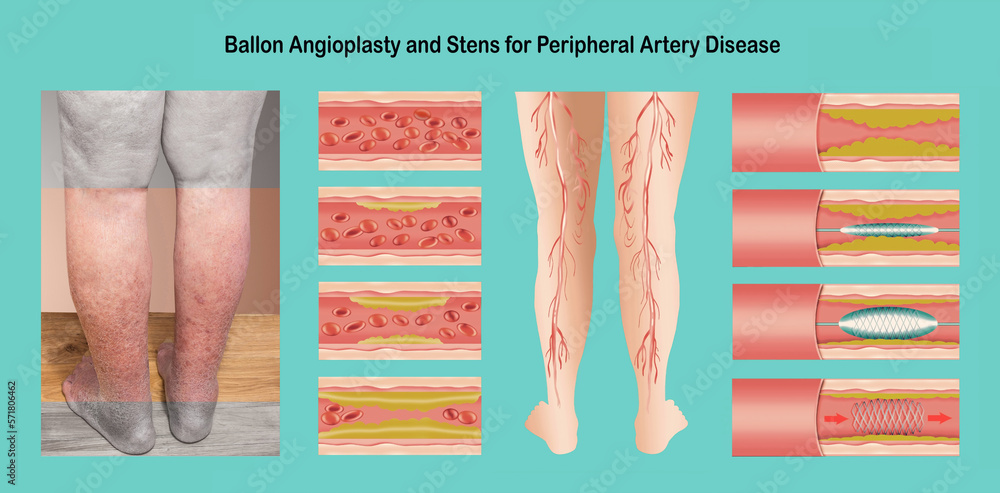Diagram showing angioplasty for peripheral artery disease illustration ...