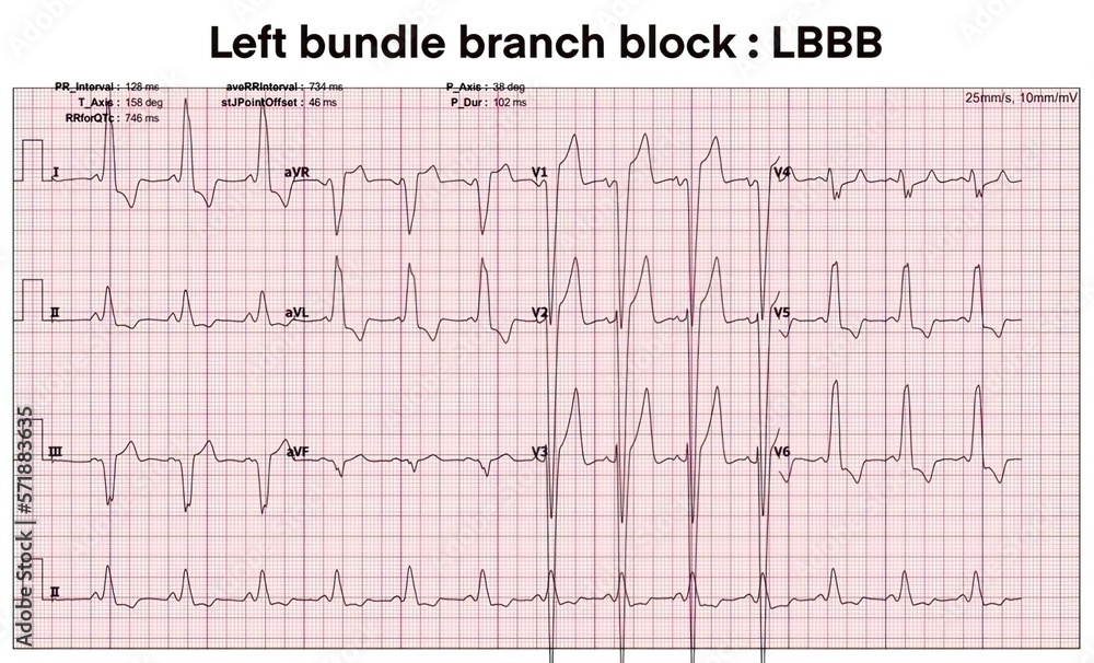 Stock-Illustration „Electrocardiogram show Left bundle branch block ...
