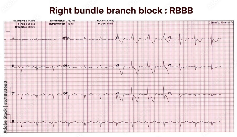 Electrocardiogram show Right bundle branch block. RBBB.Heart beat. CPR ...