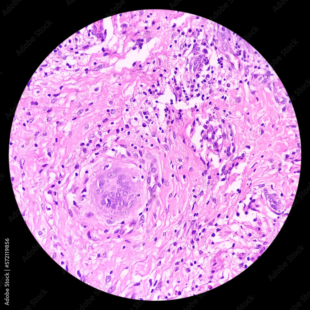 Perianal abscess tissue: Foreign body granuloma, microscopically show ...
