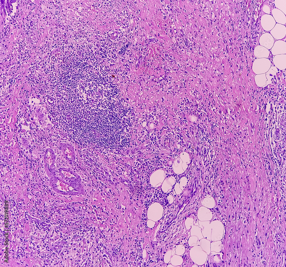Perianal abscess tissue: Foreign body granuloma, microscopically show ...