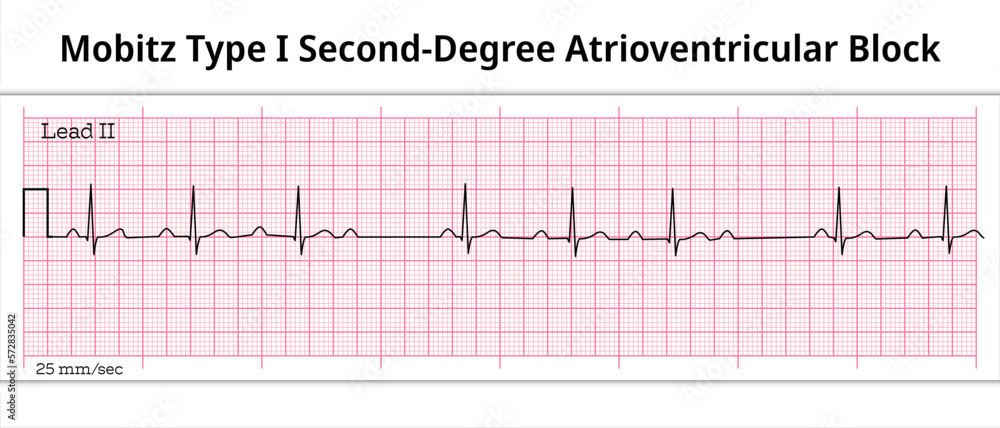 ECG Mobitz Type 1 Second Degree Atrioventricular Block - 2nd degree AV ...