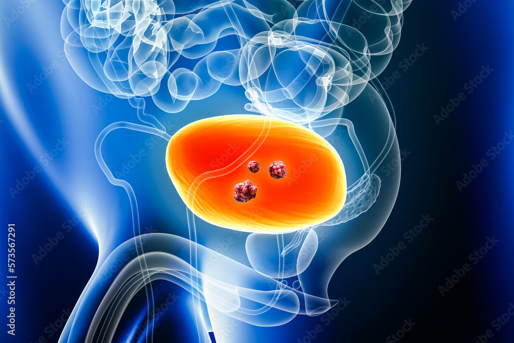Urinary bladder cancer with organs and tumors or cancerous cells 3D ...