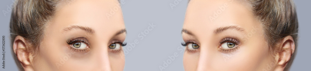 Tear Trough Filler,A-frame deformity. Fat grafting or dermal filler ...